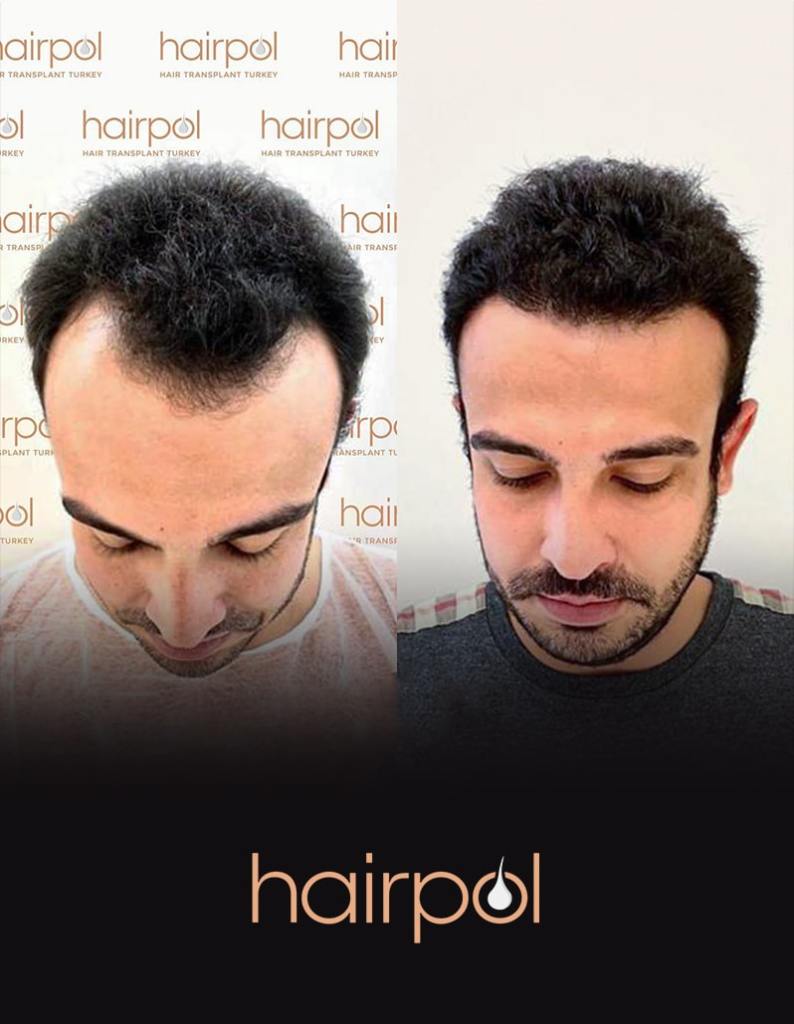 Turkish Hair - International Hair Transplant Packages from Australia