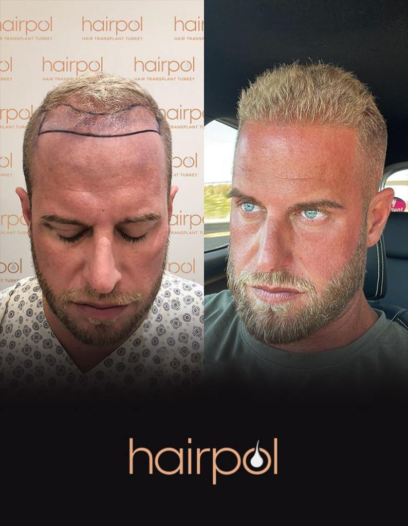 Turkish Hair - International Hair Transplant Packages from Australia