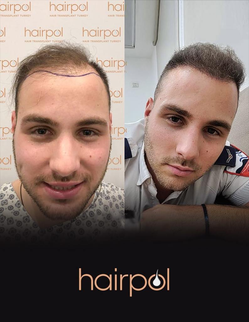 Turkish Hair - International Hair Transplant Packages from Australia